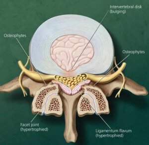 Thecal Sac - Definition, Compression (Symptoms and Treatment)