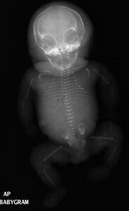 Anasarca - Definition, Causes and Treatment