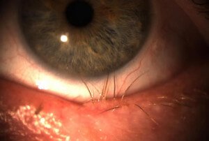 Trichiasis or Ingrown Eyelash : Definition, Causes, Surgery