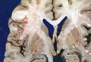 Encephalomalacia - Definition, Symptoms, Prognosis, Treatment