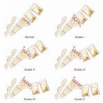Anterolisthesis - Grading, Causes, Treatment and Diagnosis