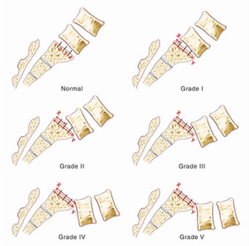Anterolisthesis Grading Causes Treatment And Diagnosis updated 