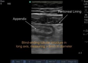 What side is your appendix on